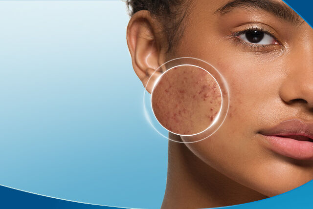 Produtos para pele acneica | Cetraphil